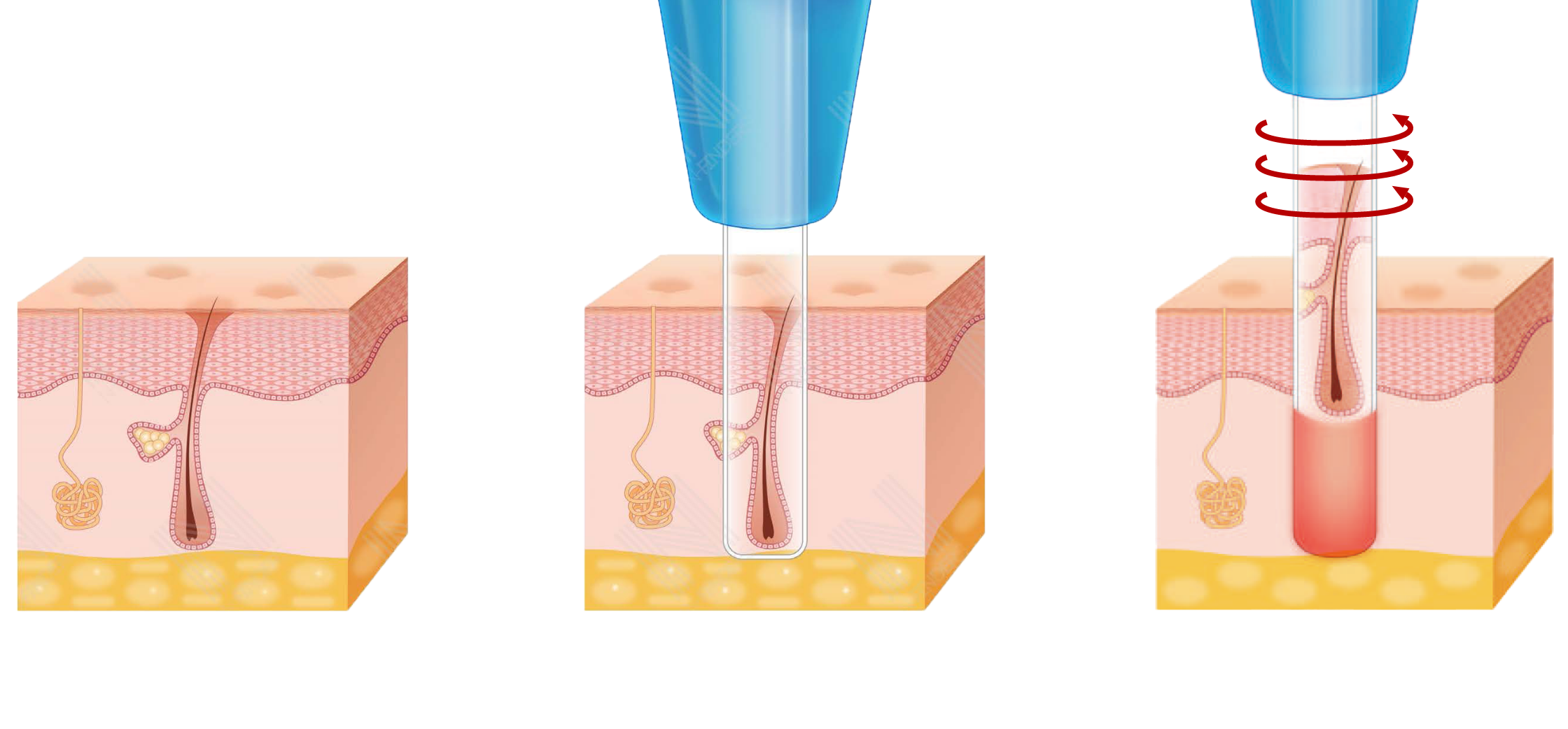 N-DERM - タトゥー除去専門の美容クリニック ziz CLINIC ―ジズクリニック―